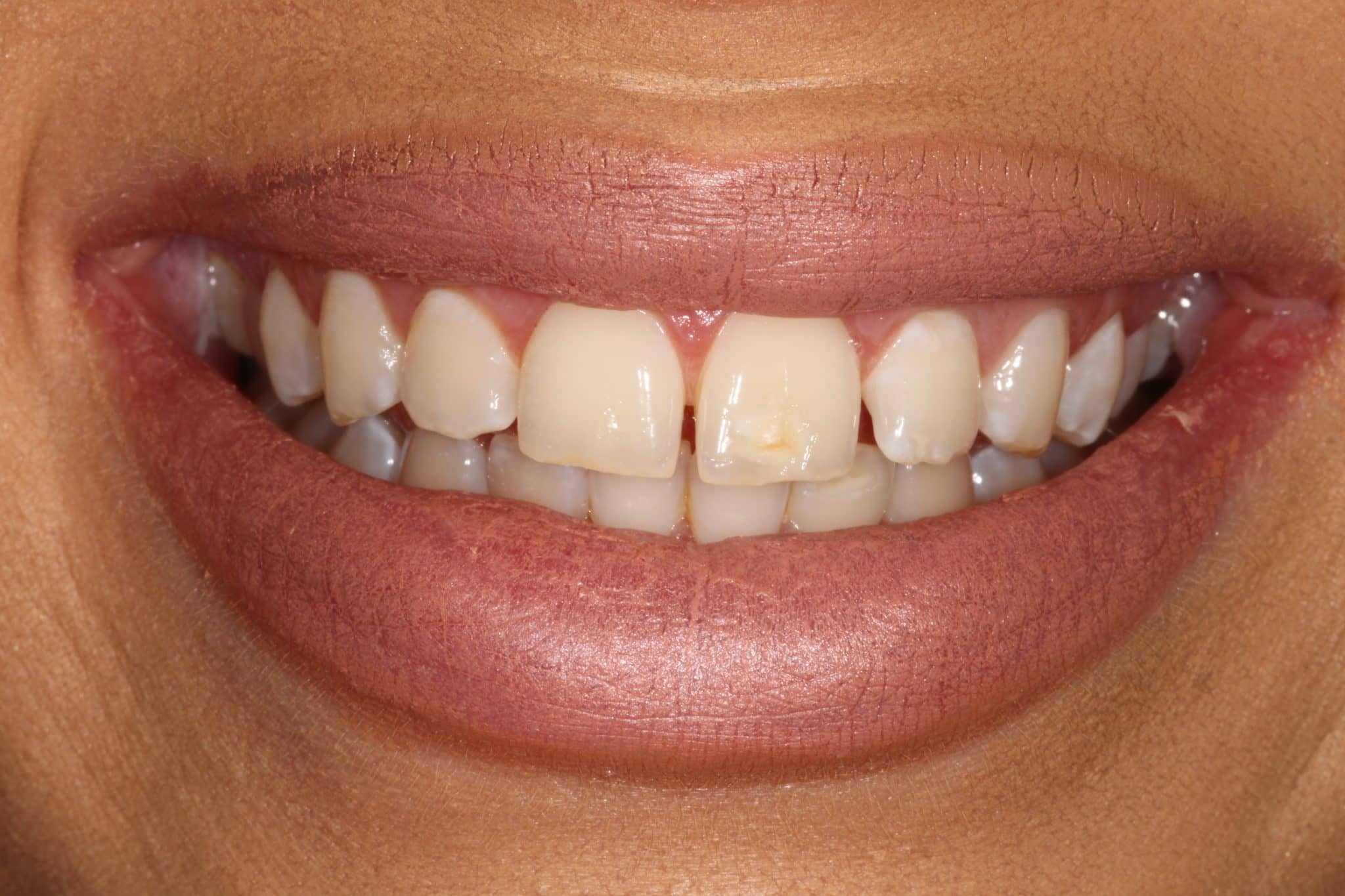 Composite Bonding Norwich Newmarket Road Dental Practice composite-bonding-norwich-newmarket-road-dental-practice